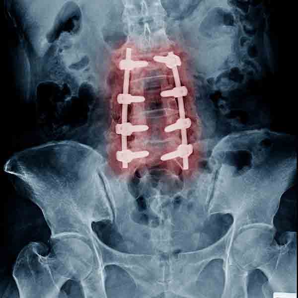 Minimally Invasive Spine Surgery NJ | Champey Pain & Spine